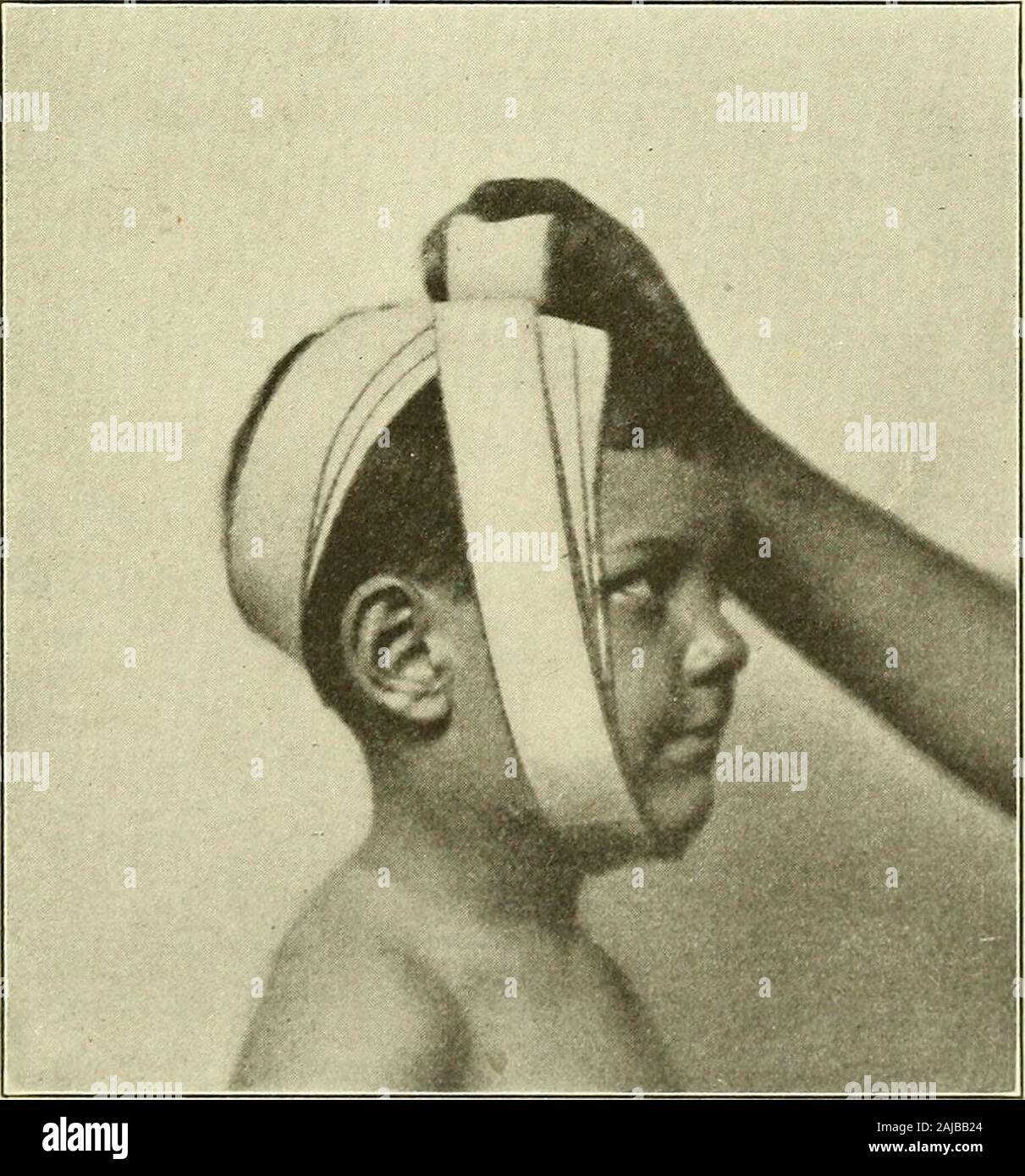 Preparatory and after treatment in operative cases . Fig. 241.—Double ...