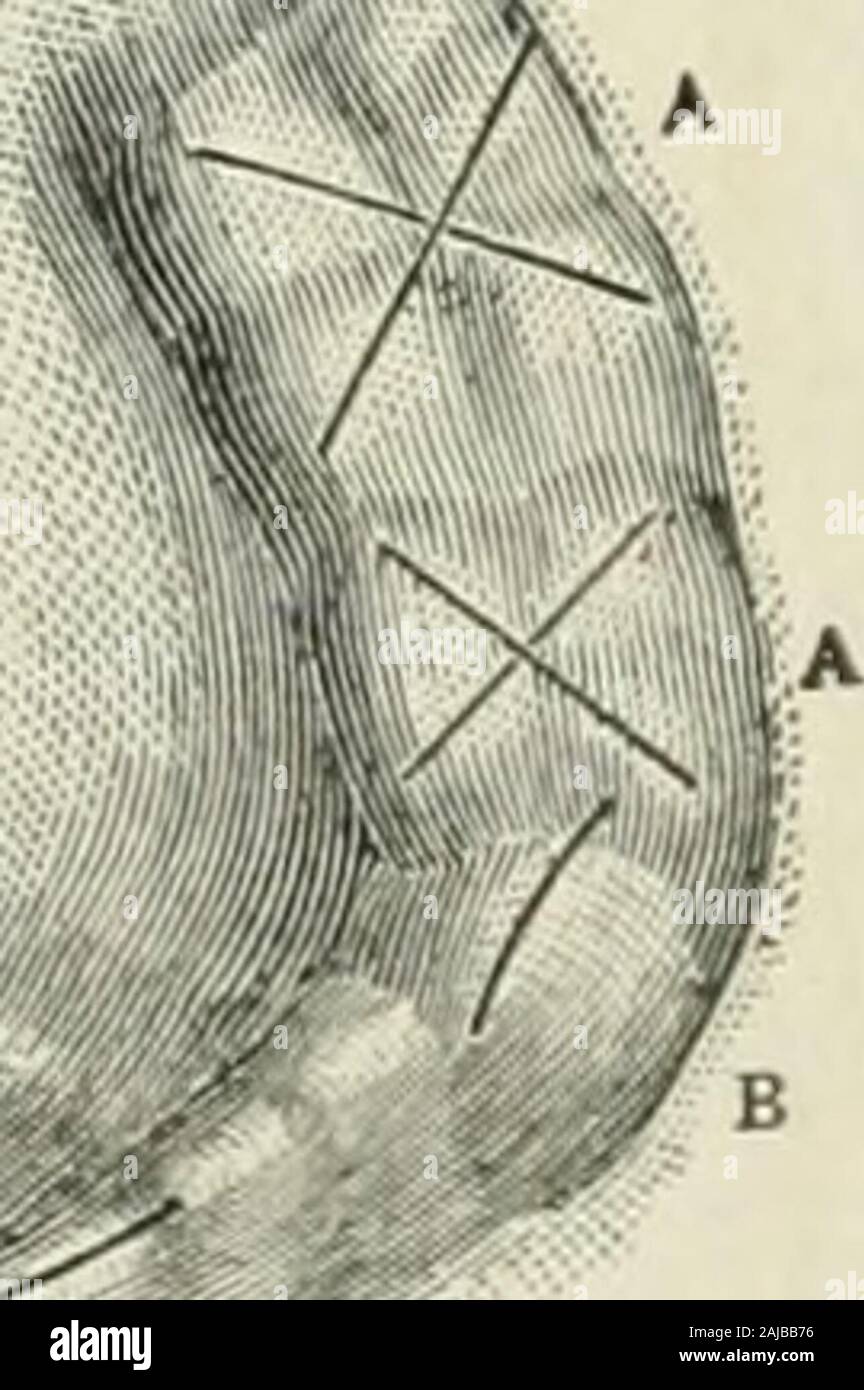 Dental Advertiser . Showing lines of incision in lancing. a, A, over ...