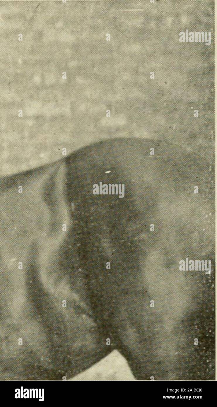 Tent wound hi-res stock photography and images - Alamy