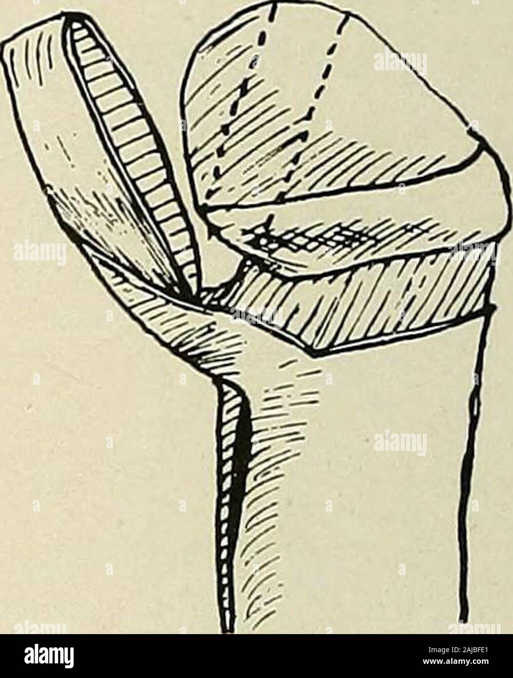 Hypospadias hi-res stock photography and images - Alamy