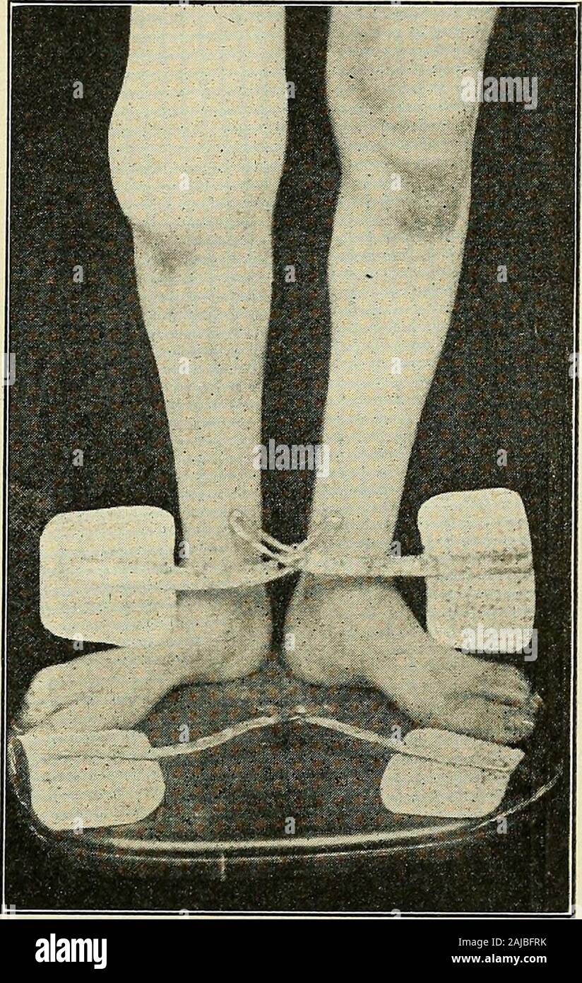 Tibia splint hi-res stock photography and images - Alamy