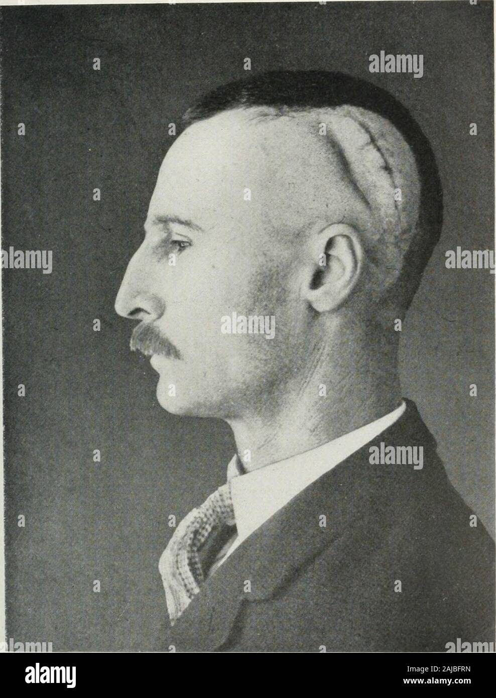 Annals of surgery . Fig. 2.—Flap of temporal fascia reflected so as to ...