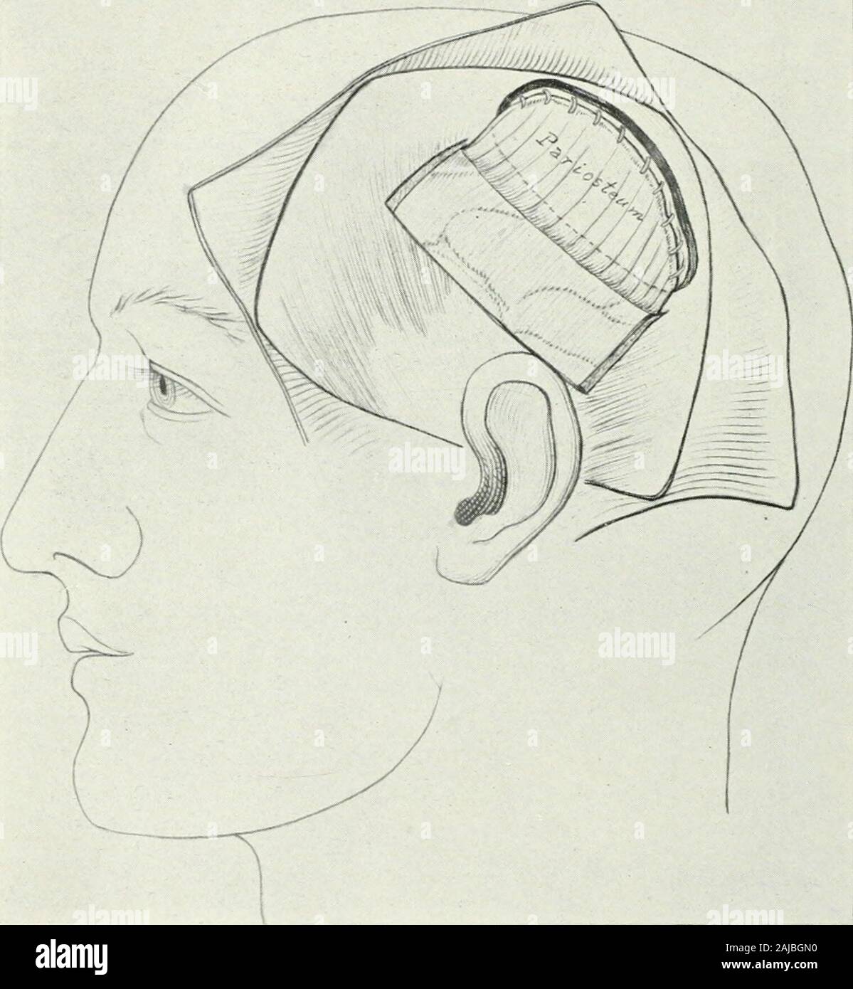 Brain surface surgery hi-res stock photography and images - Alamy