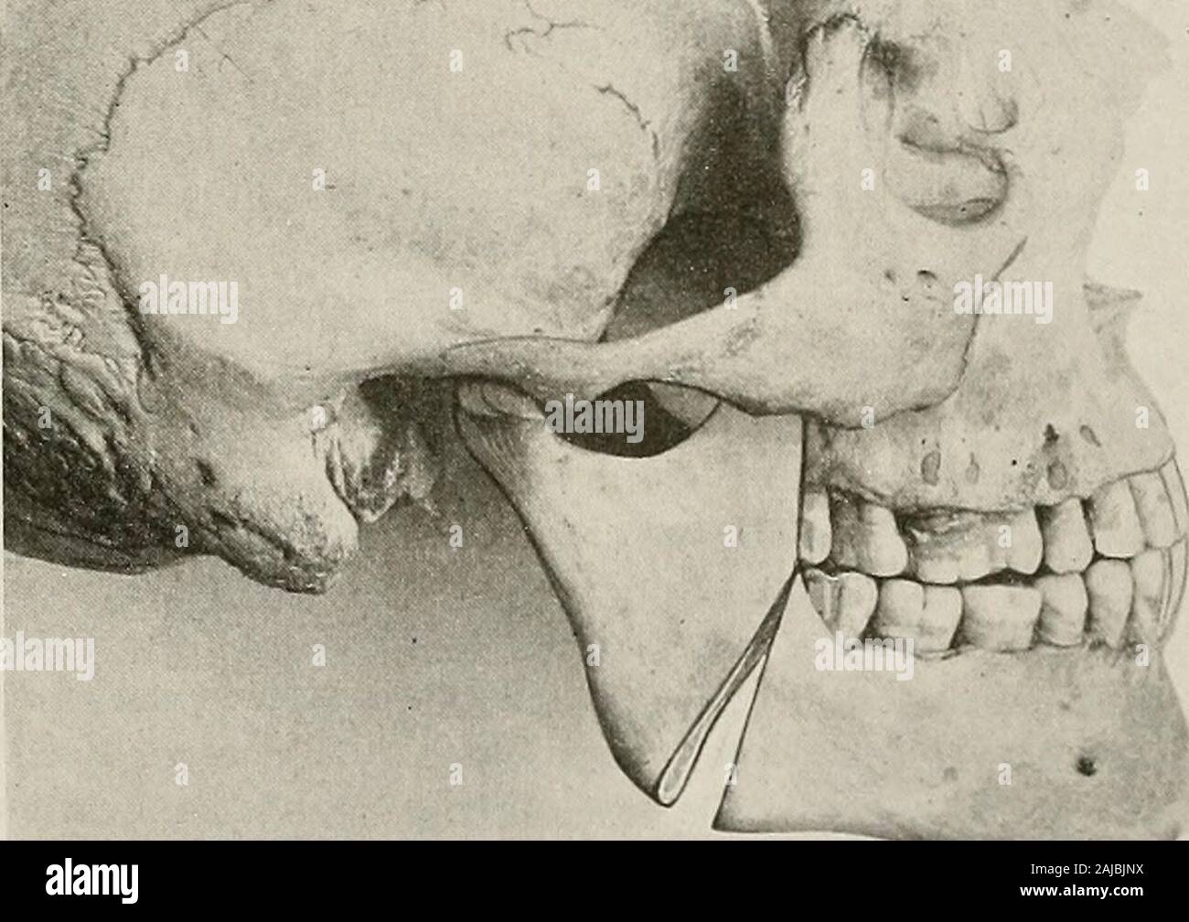 Neck abscess hi-res stock photography and images - Alamy