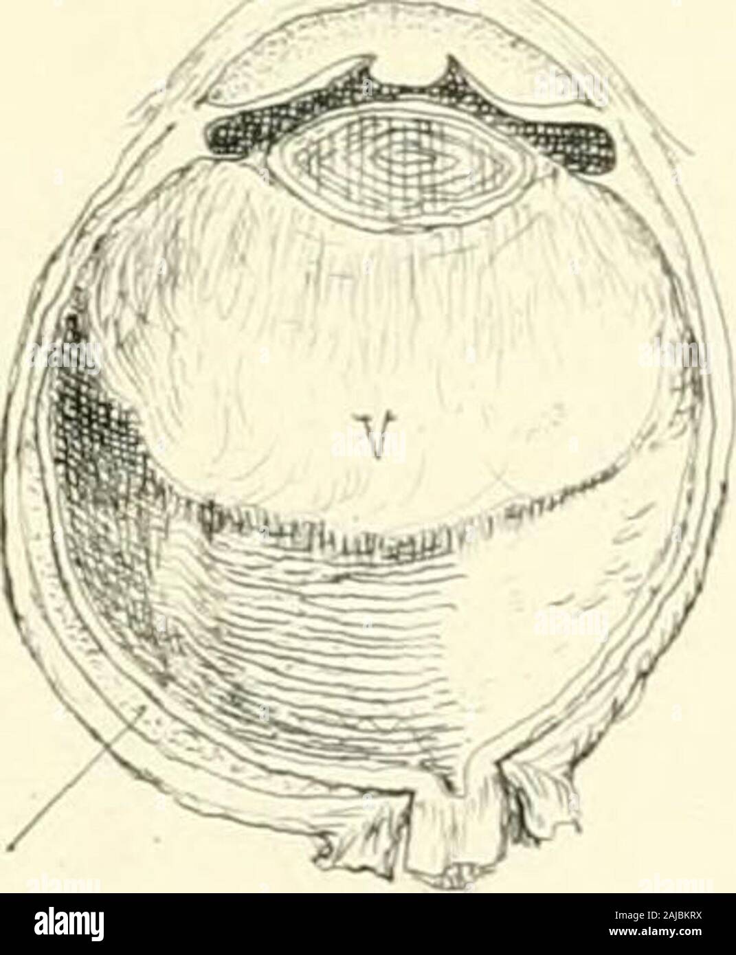 Eye enucleation hi-res stock photography and images - Alamy