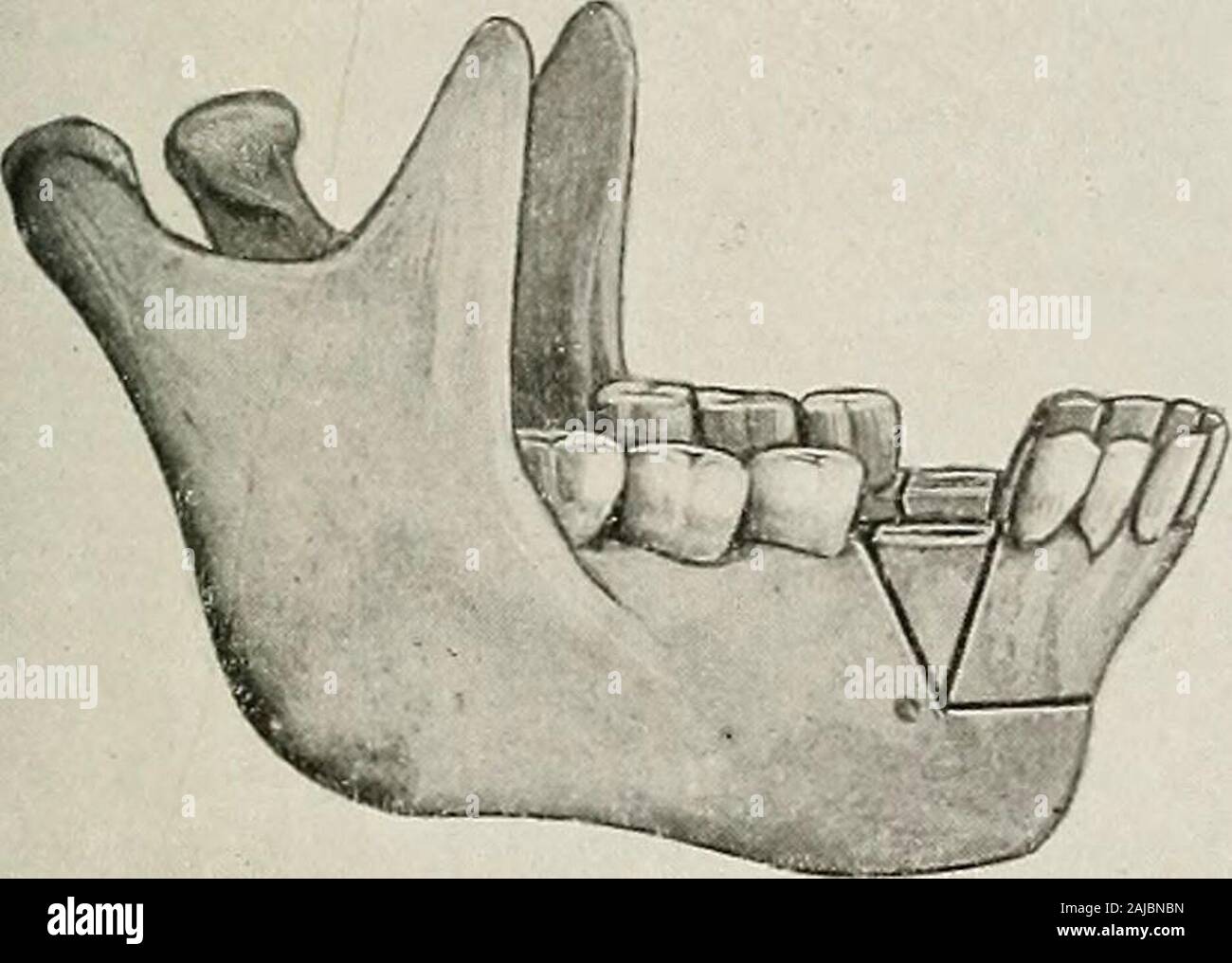 Bone graft in the neck hi-res stock photography and images - Alamy