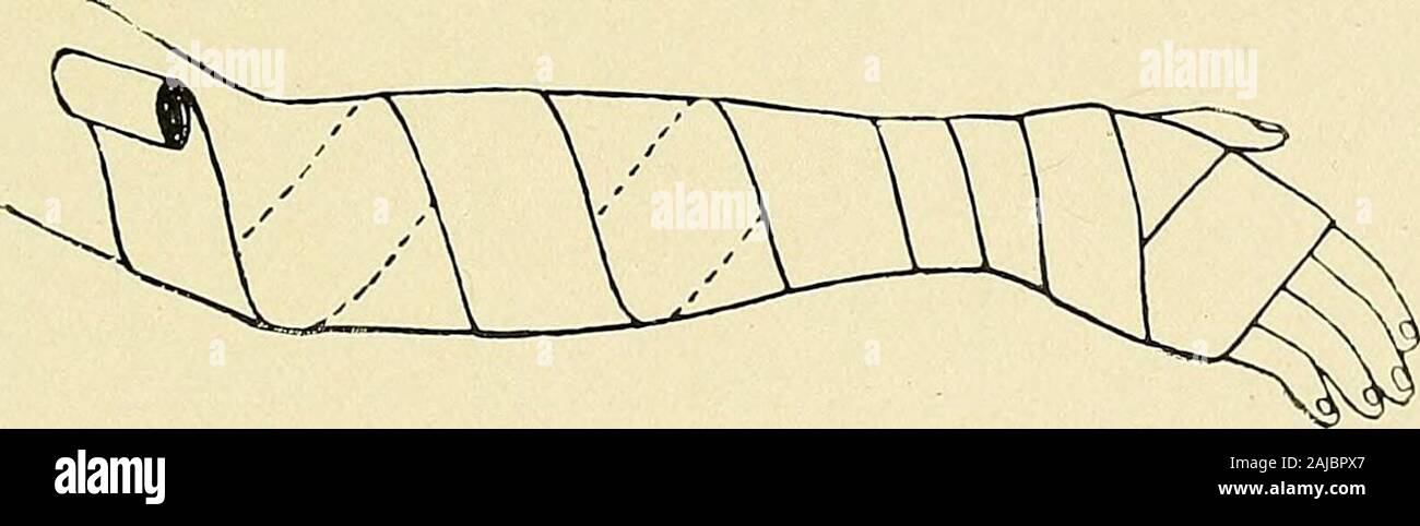 The principles and practice of bandaging : by Gwilym G Davis . 14.—The ...