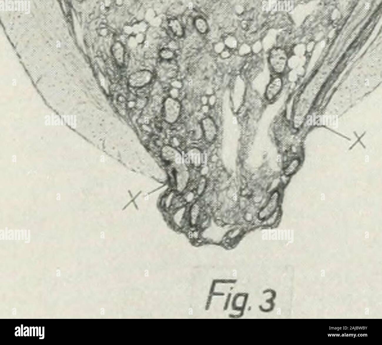Annals of surgery . 3tt ^ ?^^^0 r c%. %?* j FALSE DIVERTICULA OF ...