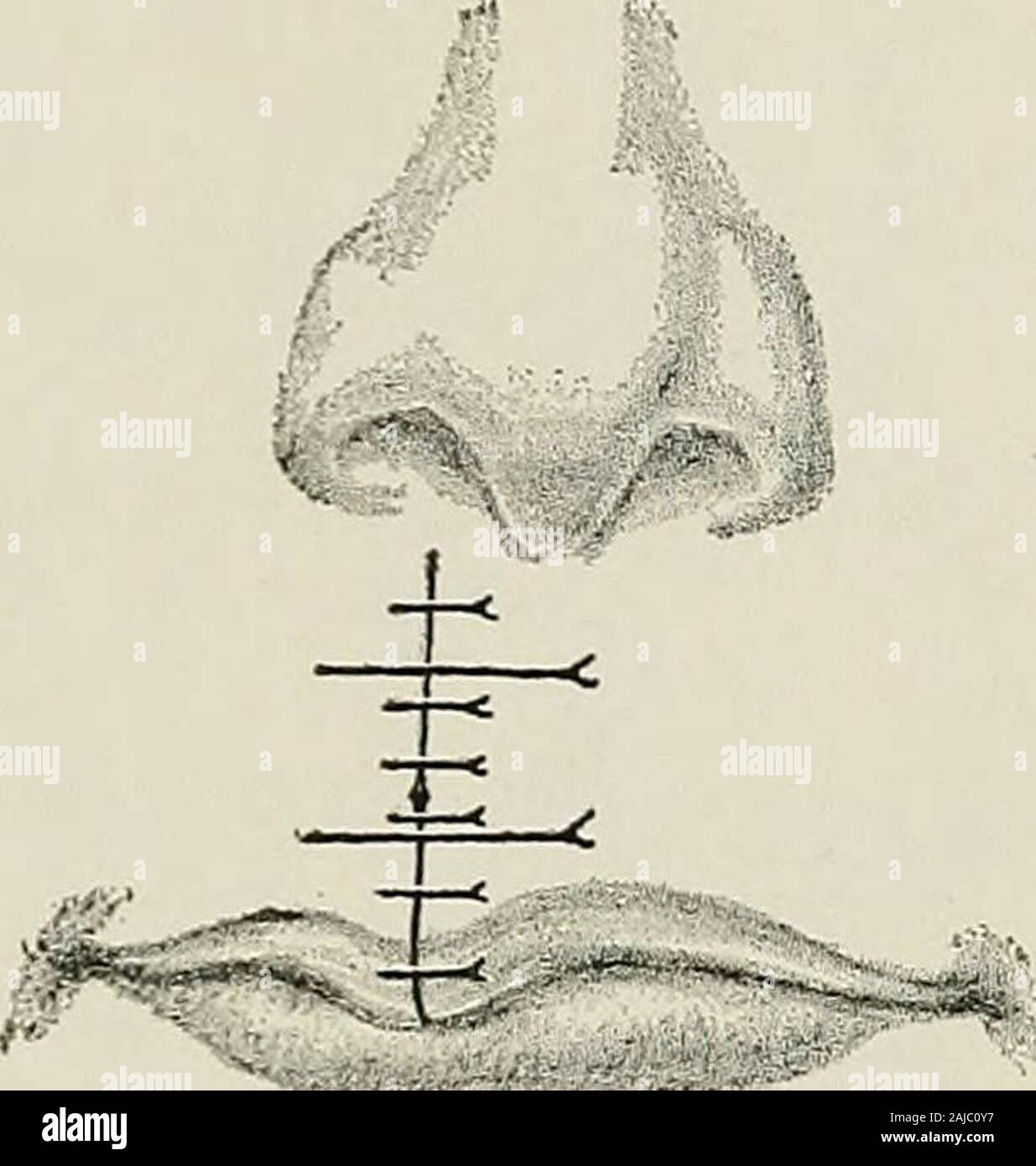 Skin sutured hi-res stock photography and images - Alamy