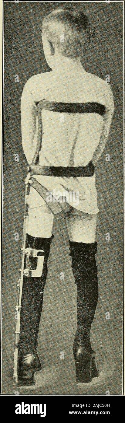 The thomas splint hi-res stock photography and images - Alamy