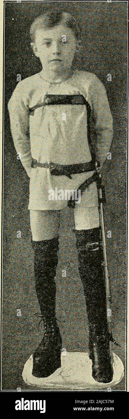 The thomas splint hi-res stock photography and images - Alamy