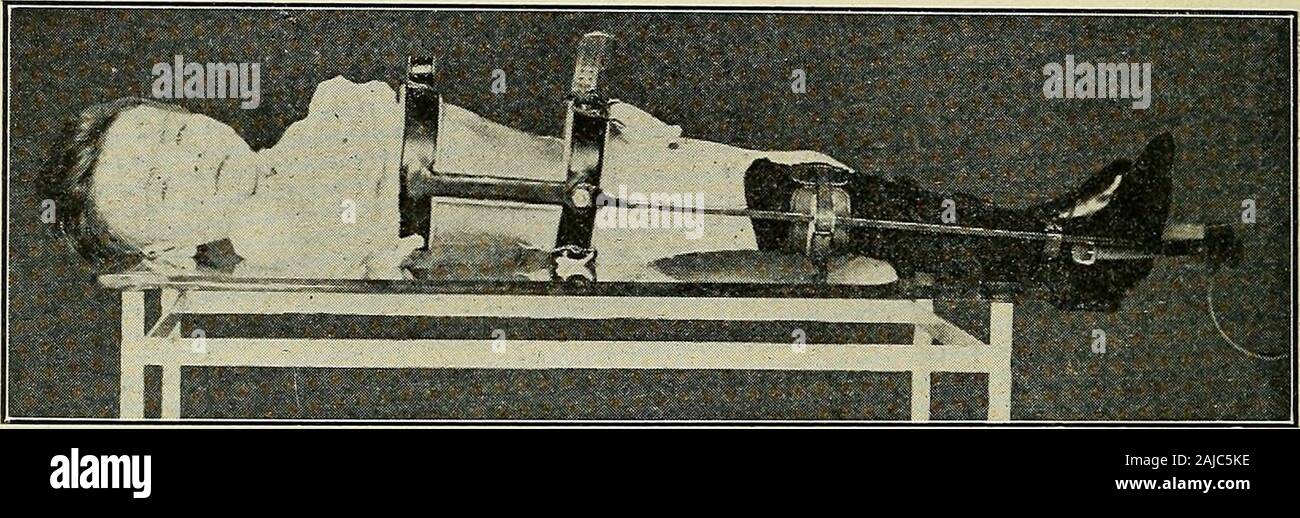 A treatise on orthopedic surgery . The long, inexpensive brace, witli ...