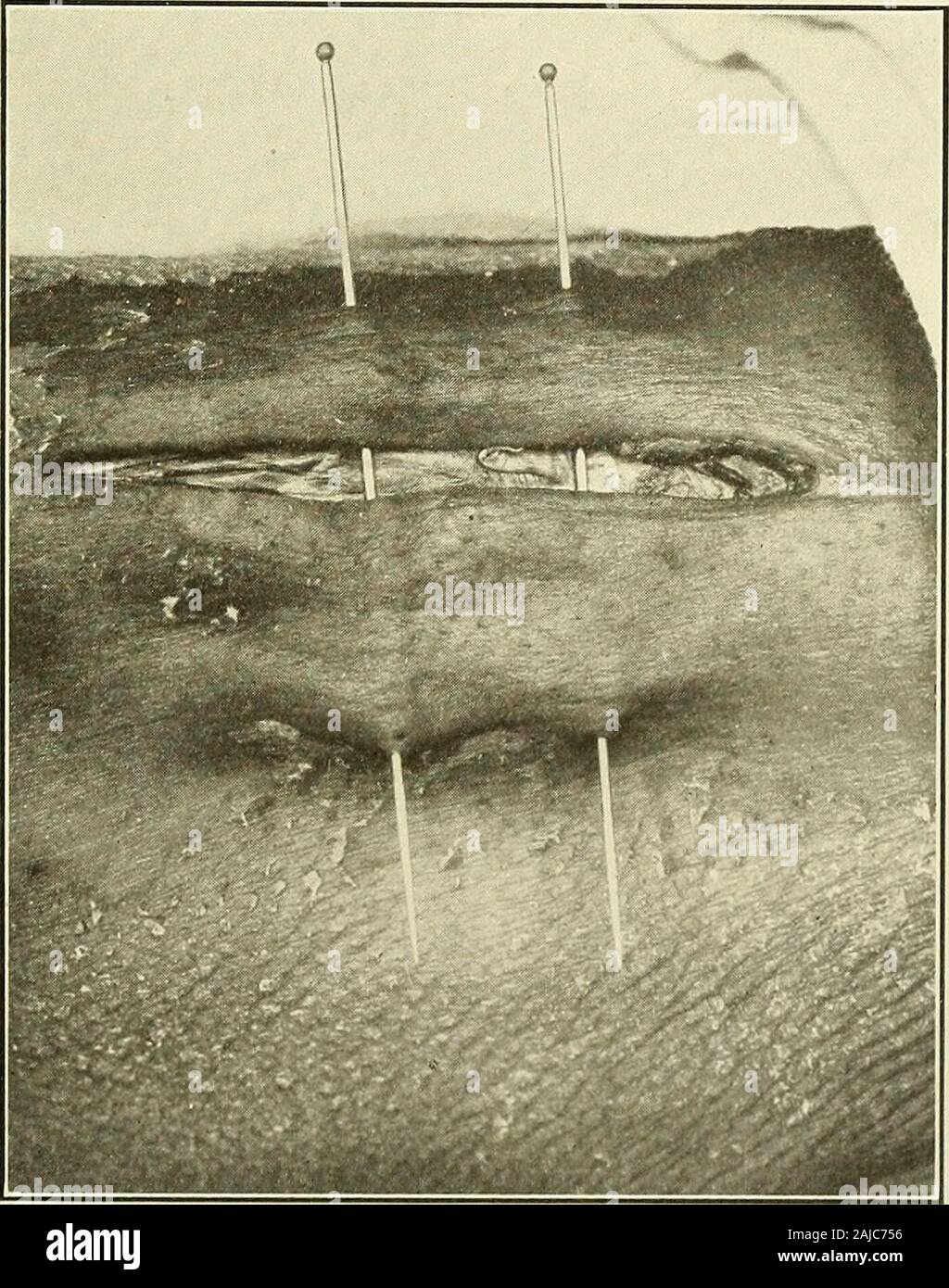 Preparatory and after treatment in operative cases . Fig. 181.—Tension ...