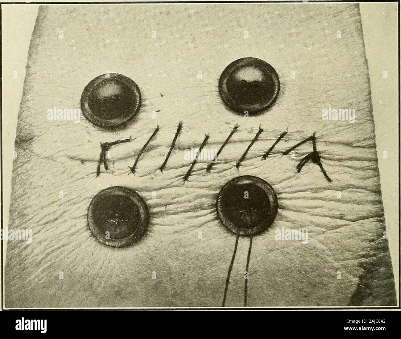 Preparatory and after treatment in operative cases . Fig. 179 ...