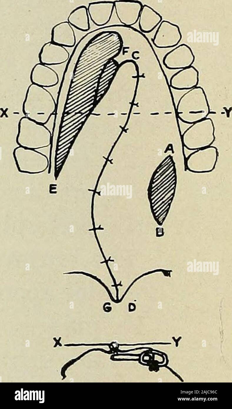 Plastic surgery; its principles and practice . Fig. 253.—The flap ...