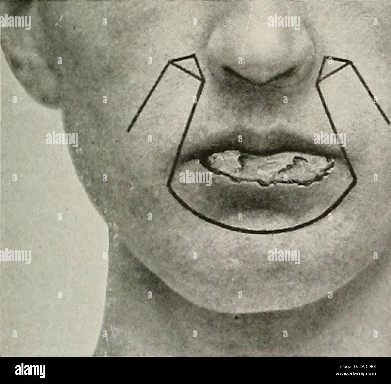 Surgical treatment; a practical treatise on the therapy of surgical ...