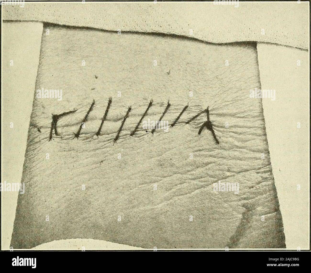 Continuous suture hi-res stock photography and images - Alamy