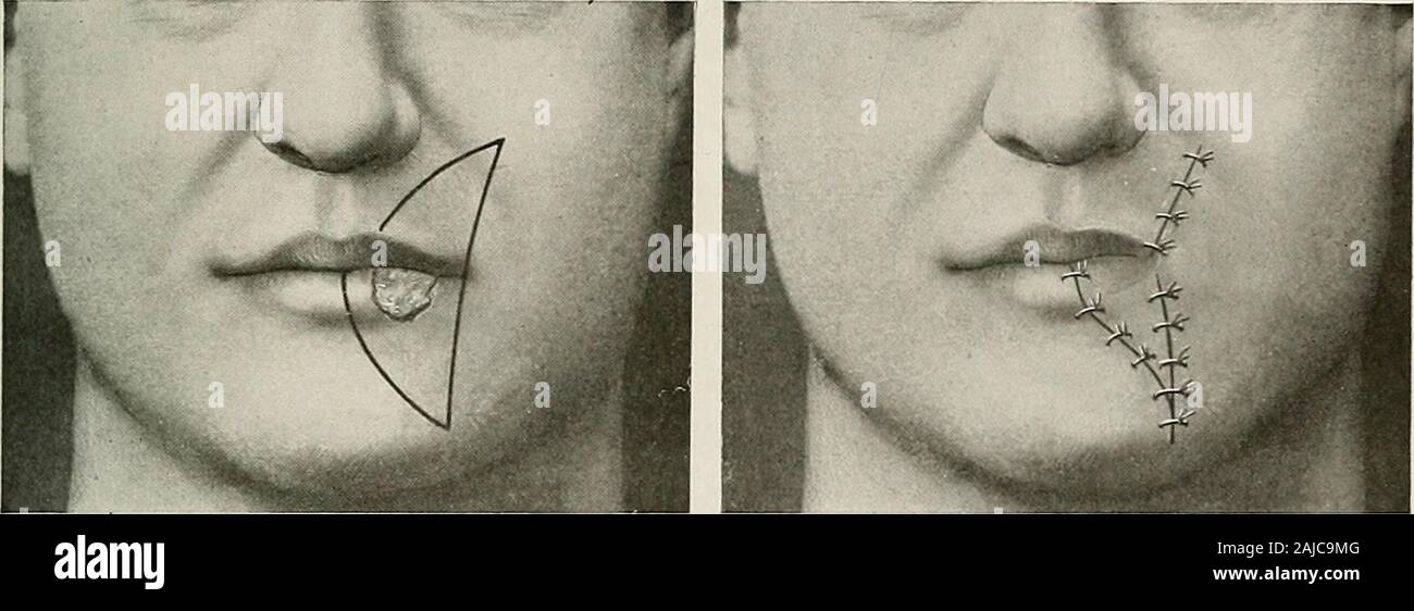 Lateral flaps hi-res stock photography and images - Alamy