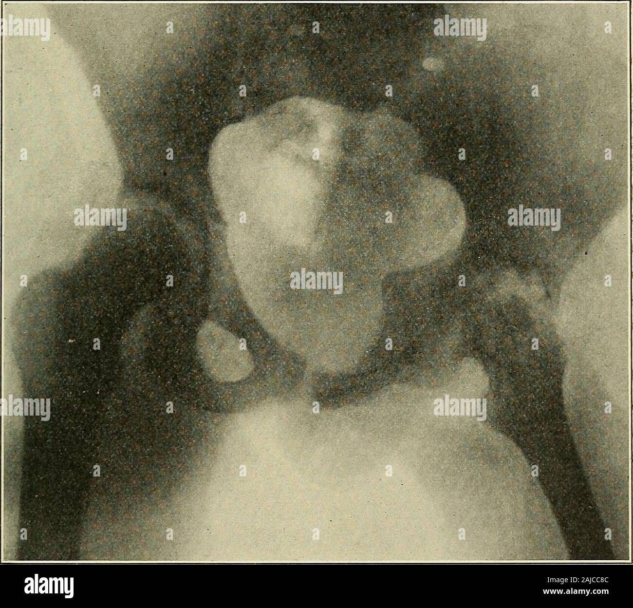 Showing the muscles of the hip hi-res stock photography and images - Alamy