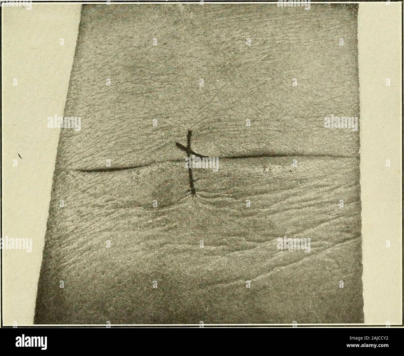 Suturing needles hi-res stock photography and images - Alamy