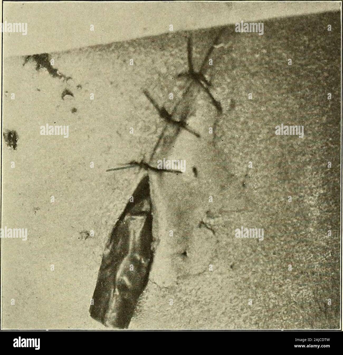 Preparatory and after treatment in operative cases . Fig. 152.—Rubber ...