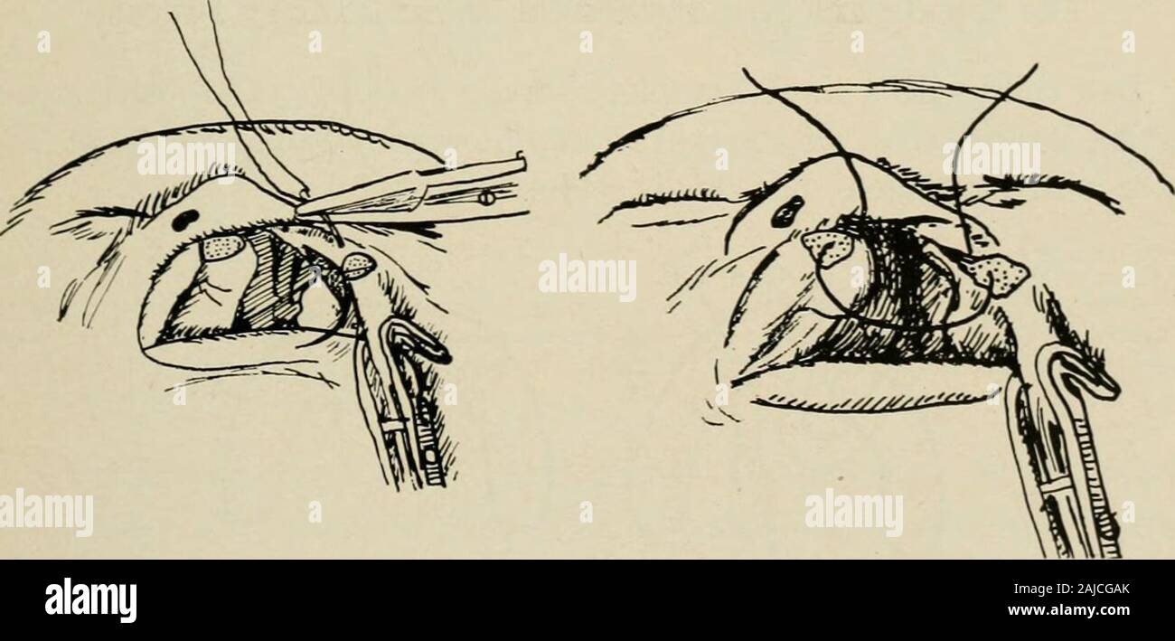 Plastic surgery; its principles and practice . Fig. 231.—Suture to ...