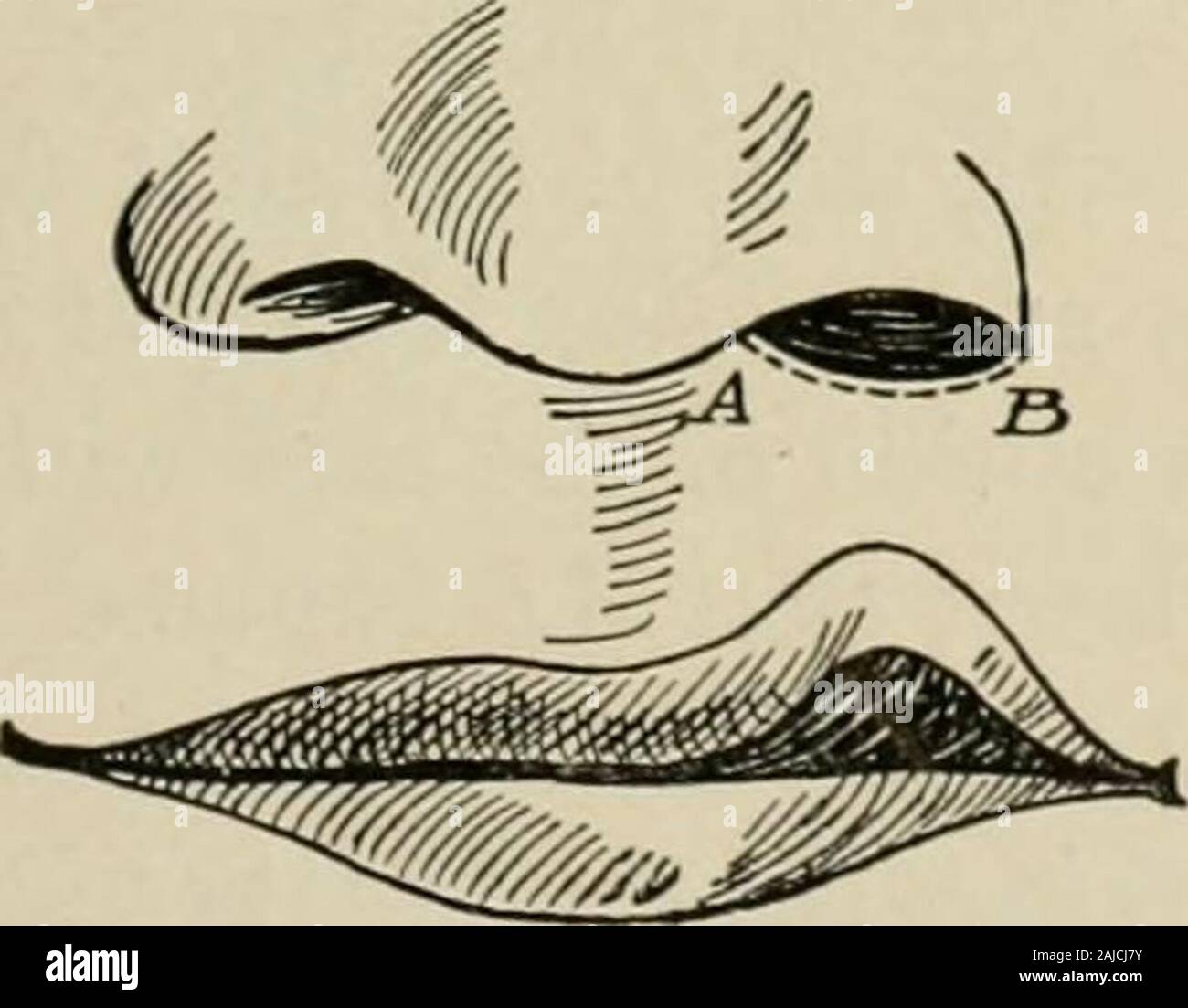 Harelip correction scar hi-res stock photography and images - Alamy