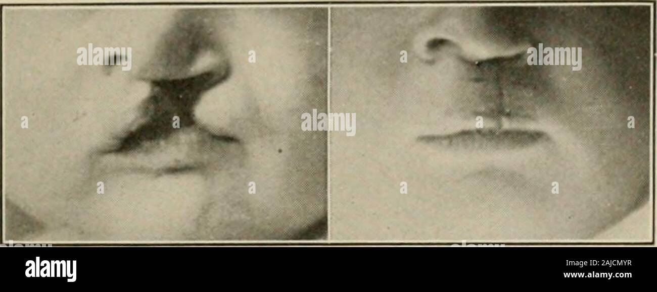 Plastic surgery; its principles and practice . Fig. 214.—Complete ...