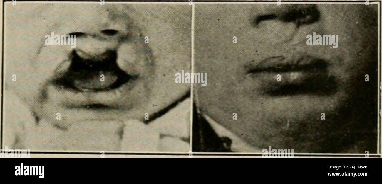 Cleft palate before and after hi-res stock photography and images - Alamy