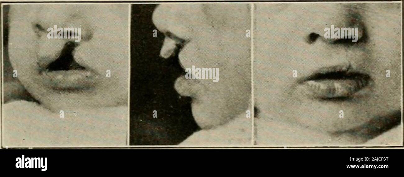 Plastic surgery; its principles and practice . Fig. 209.—Incomplete ...