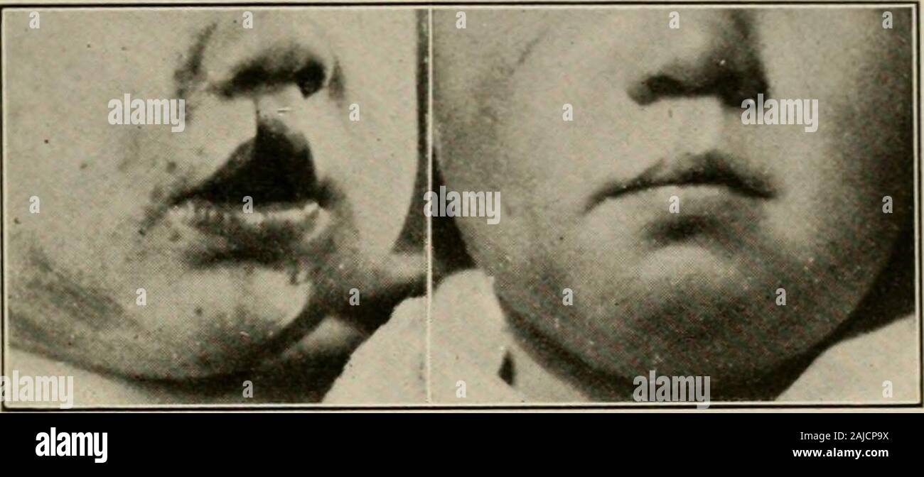 Plastic surgery; its principles and practice . HARELIP AND CLEFT PALATE ...