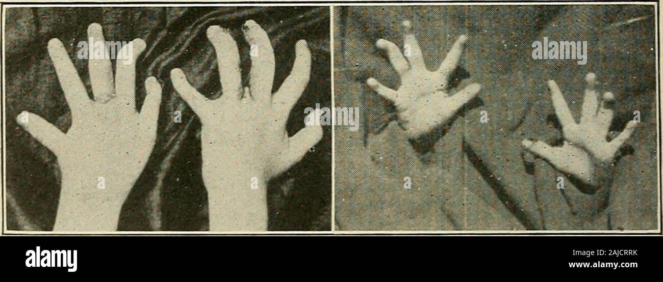 Plastic surgery; its principles and practice . Fig. 200.—Bilateral ...