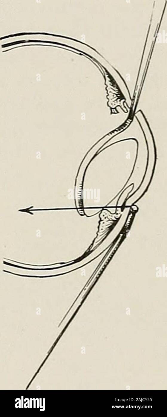 Intracapsular cataract extraction hi-res stock photography and images ...