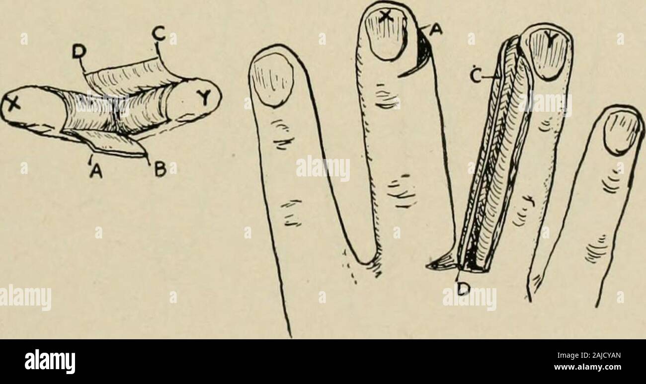 Interdigital cleft hi-res stock photography and images - Alamy