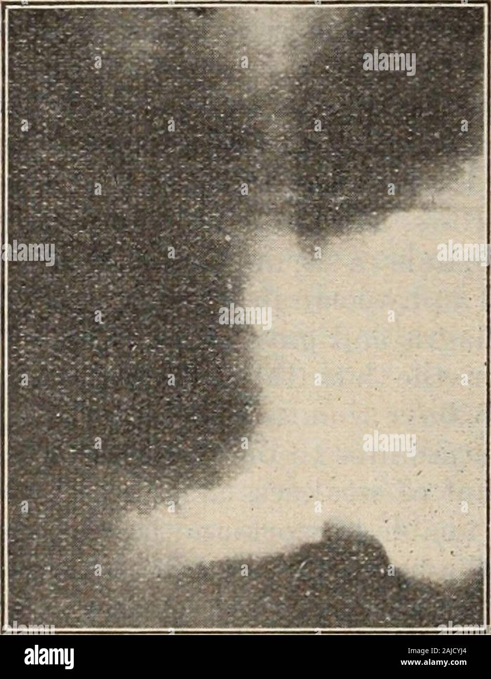 Virginia medical monthly . ii. Drawing- of the specimen removed ...