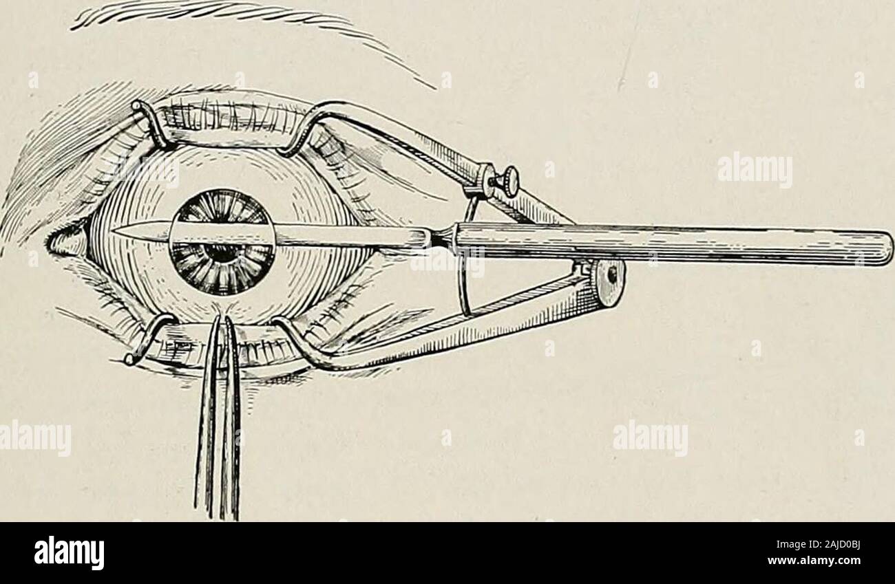 Cataract extraction surgical instruments hi-res stock photography and ...