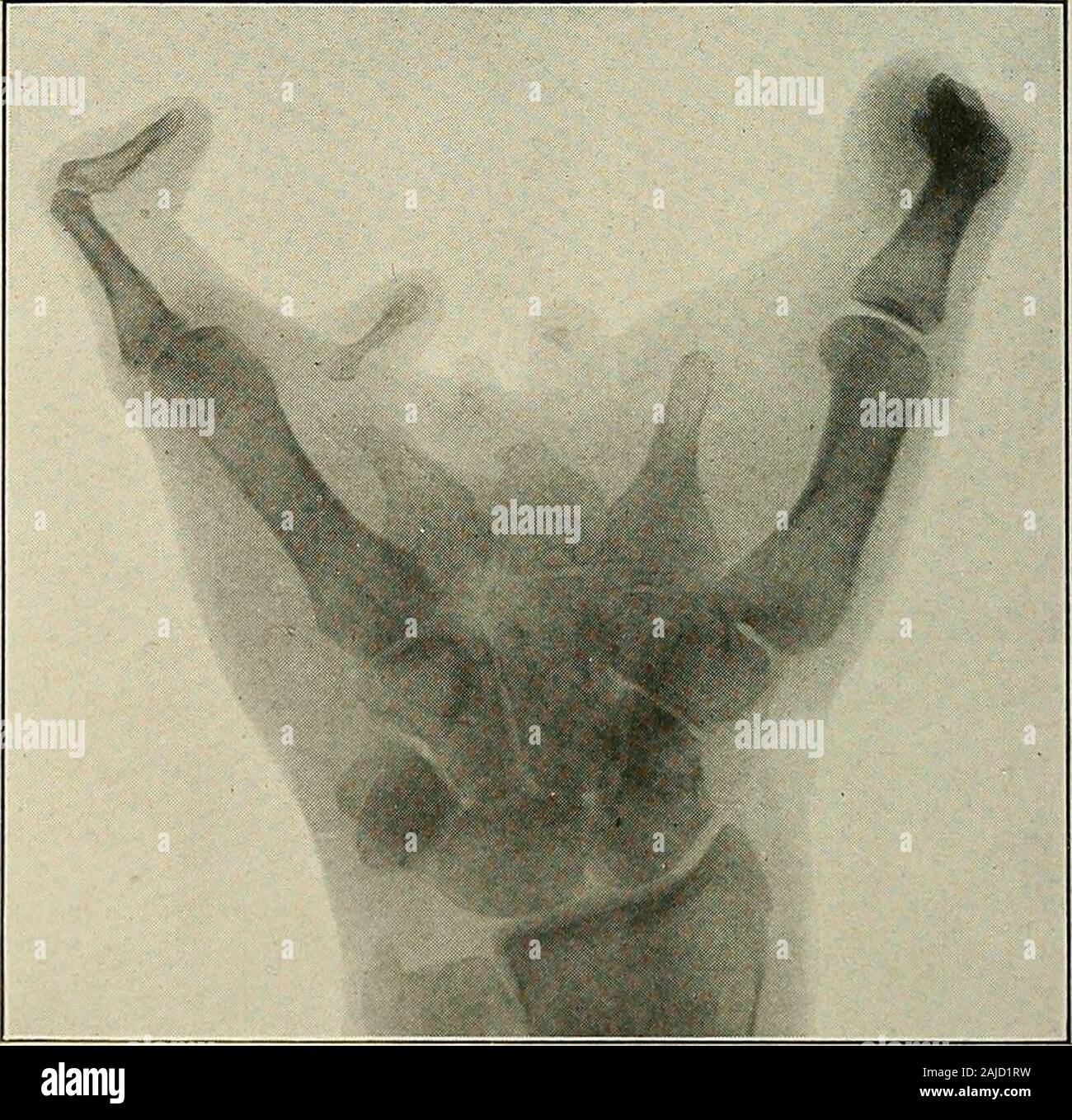 Plastic surgery; its principles and practice . Fig. 186.—Thickened ...