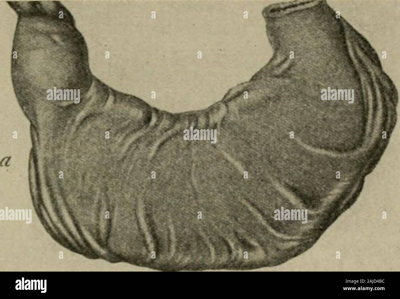 Gastric spasm hi-res stock photography and images - Alamy
