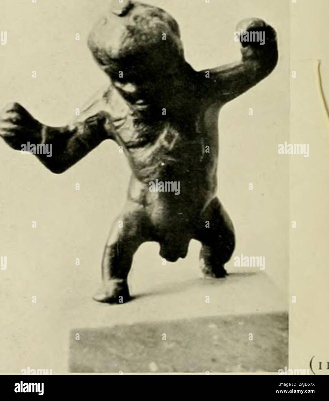 Treasury of human inheritance . Dwarf Type—1 Achondroplasic. Musee(109 ...