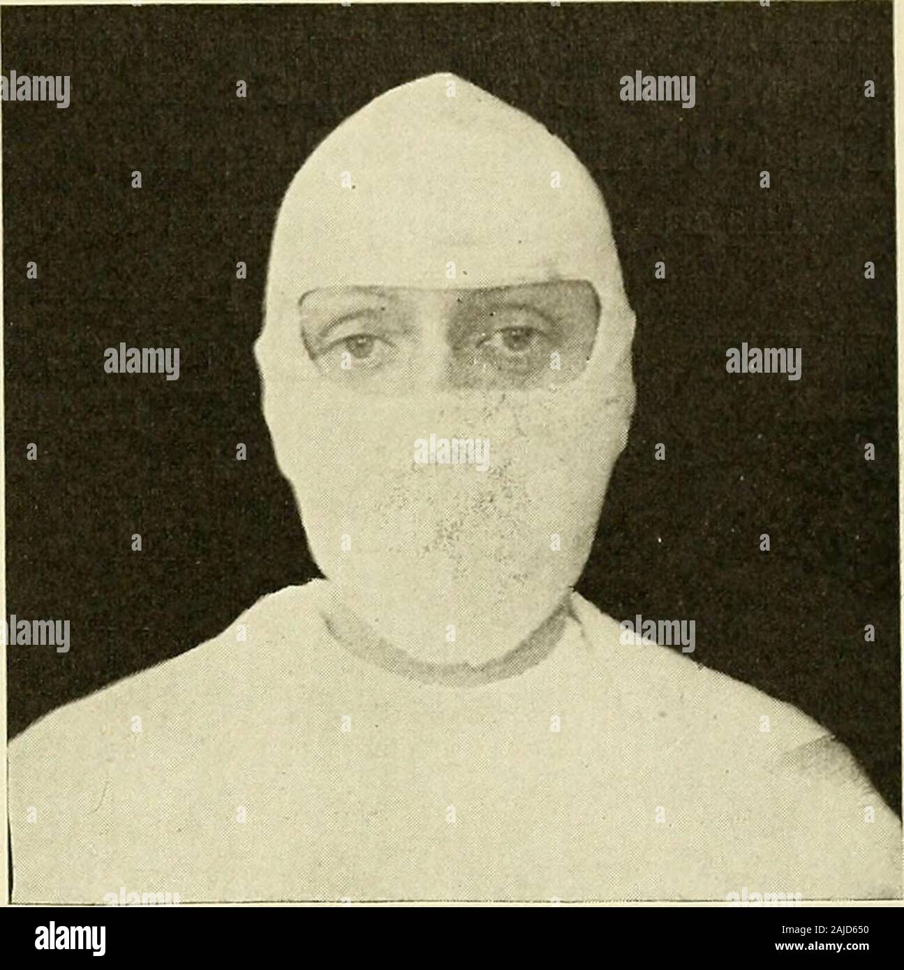 Abscess and cellulitis hi-res stock photography and images - Alamy