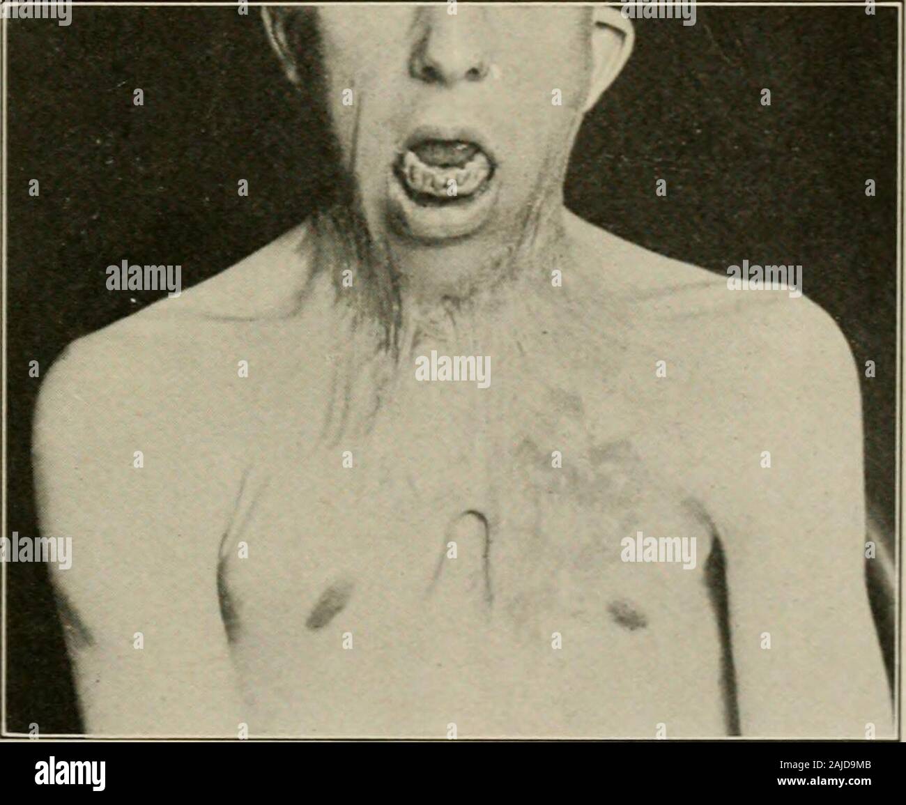 Plastic surgery; its principles and practice . Fig. 159.—Contracture of ...