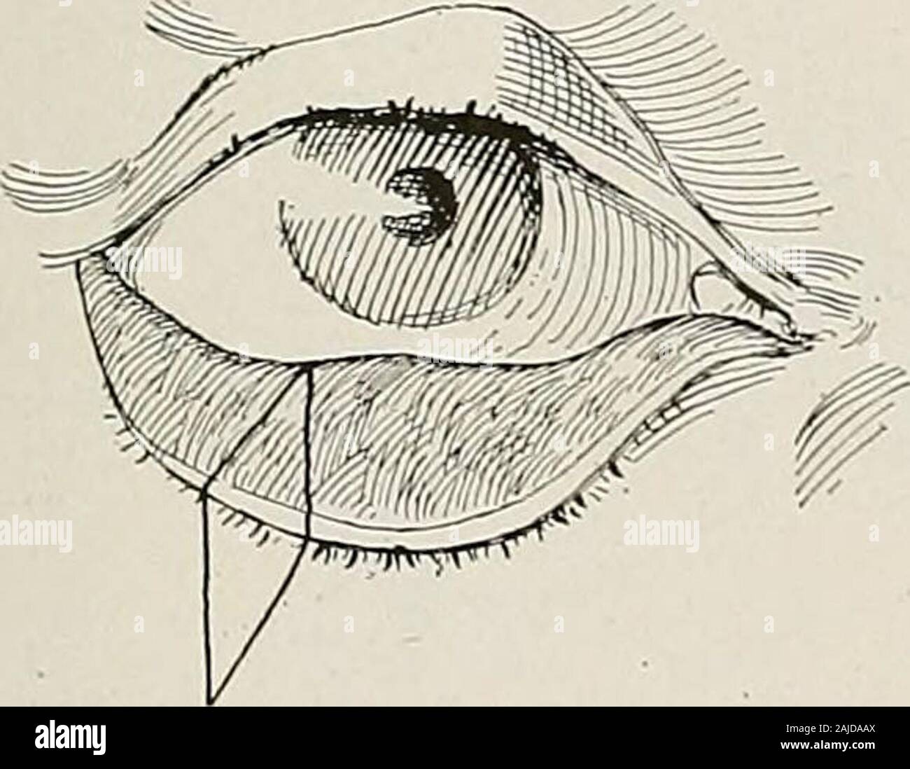 Y incision hi-res stock photography and images - Alamy