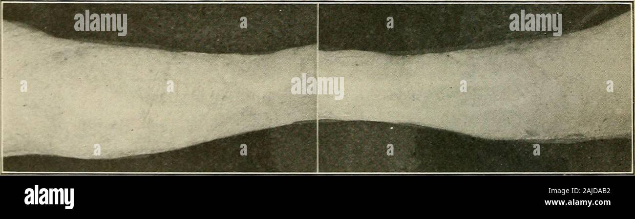 Plastic surgery; its principles and practice . Fig. 156.—Unstable scar ...