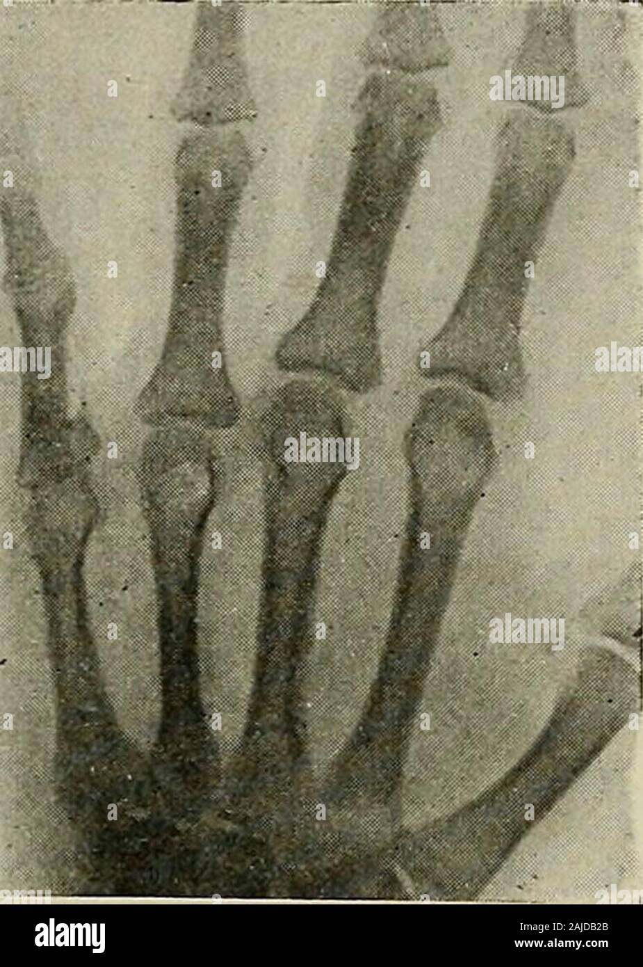 Industrial medicine and surgery . Fig. 170. Fig. 171. Fig. 170.—Bone ...