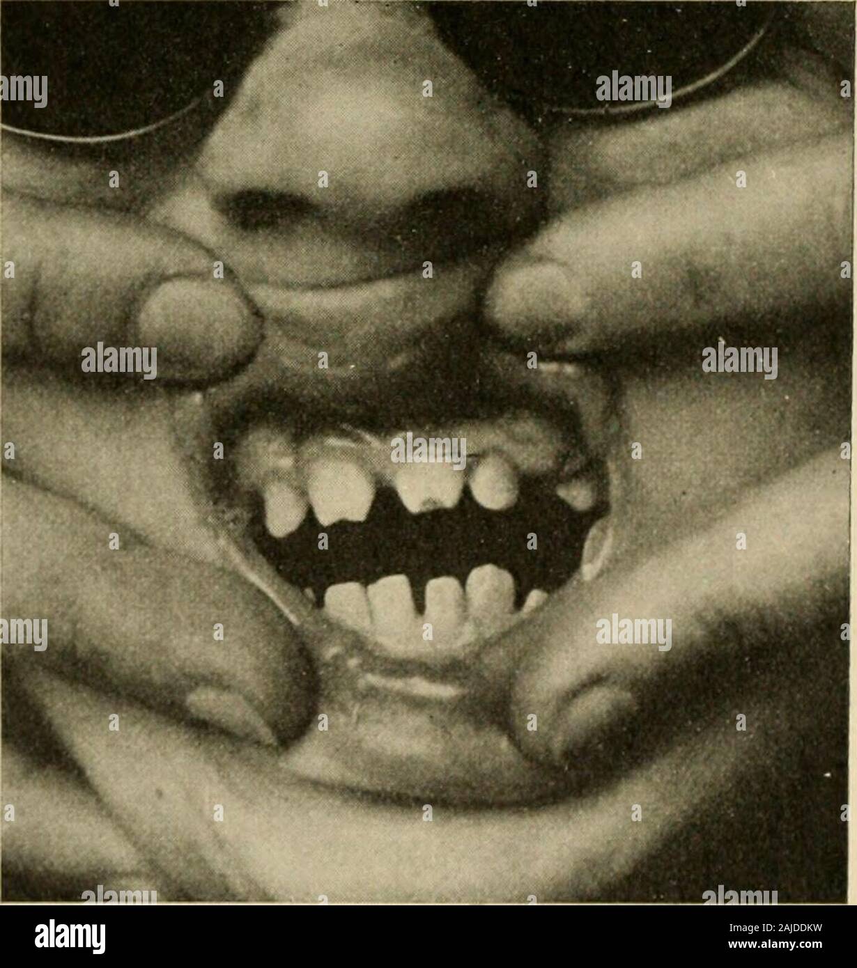 Hutchinsons Teeth Syphilis