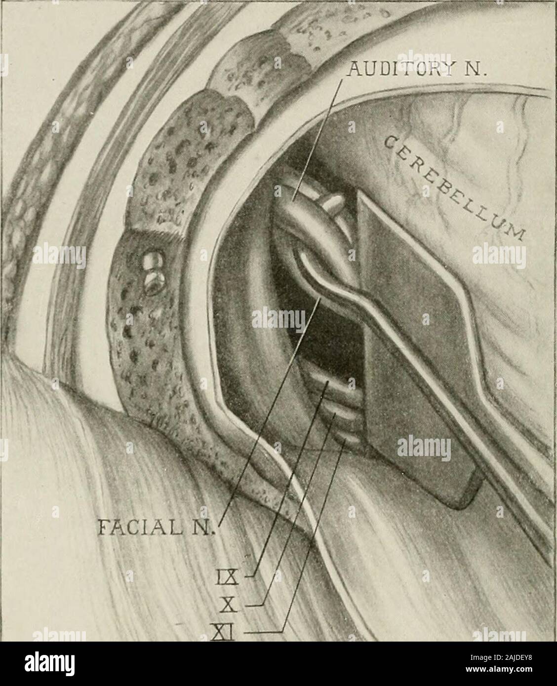 Bleeding on the brain hi-res stock photography and images - Alamy
