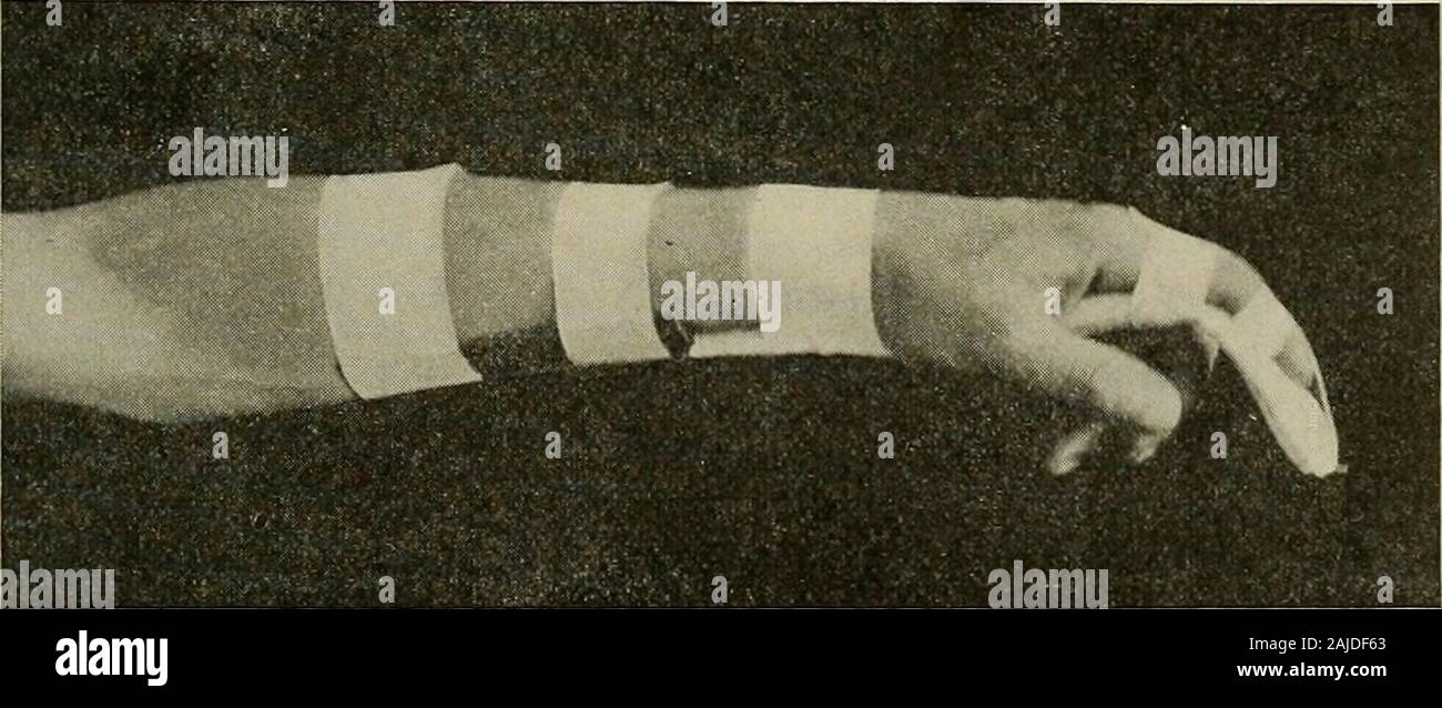 Industrial medicine and surgery . Fig. 153.-—Marsees tin finger splint ...