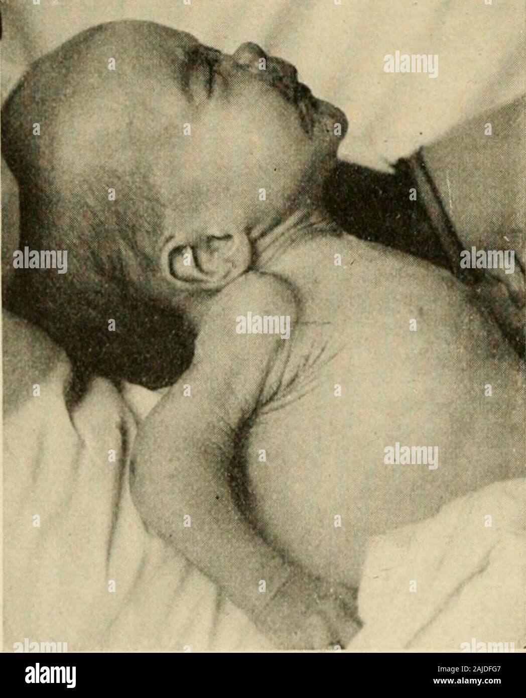 The diseases of infants and children . Fig. 189.- -Syphilitic ...