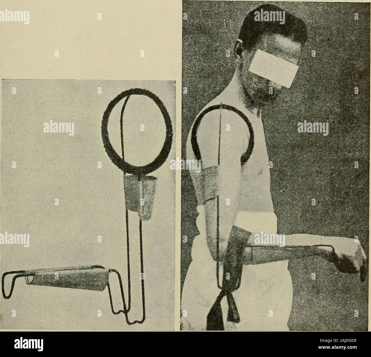 Industrial medicine and surgery . Fig. 146.—Delbet arm extension ...
