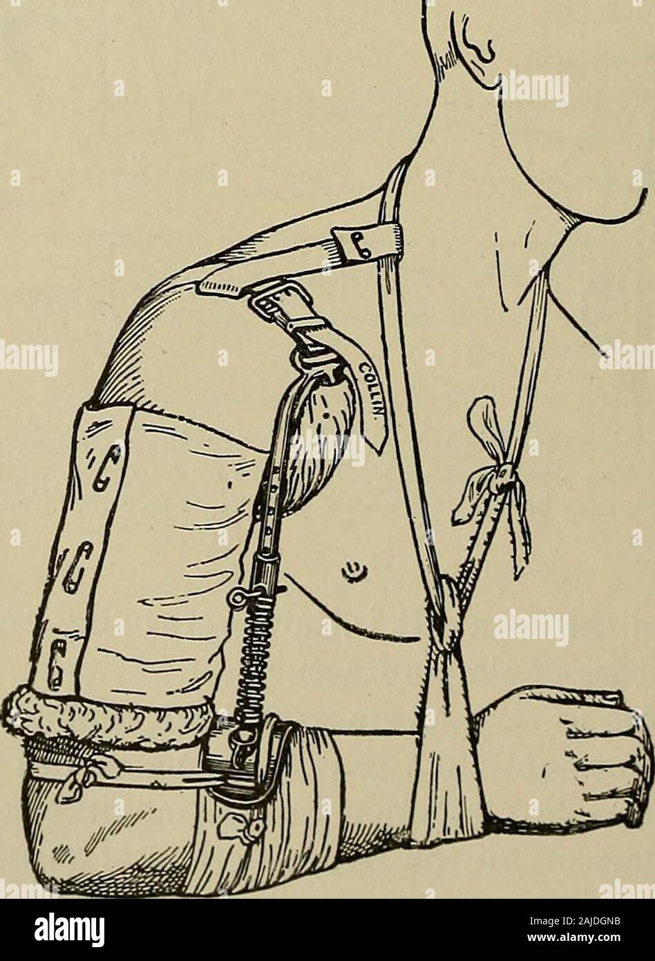Industrial medicine and surgery . Fig. 145.—Wood triangle splint used ...